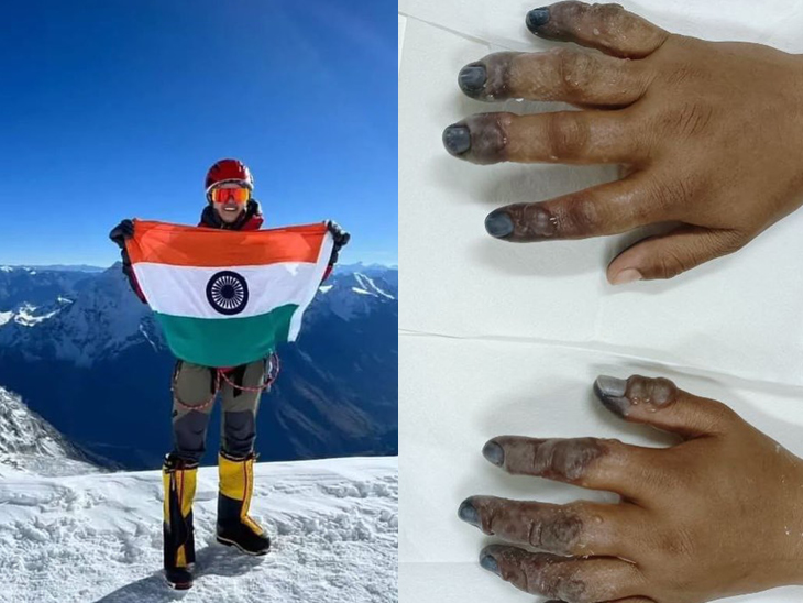 Went to climb Mount Everest and 9 out of 10 fingers turned like coal ...