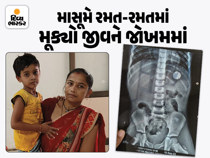A 7-year-old child in Surat swallowed a coin, reported vomiting two ...