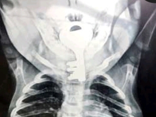 Child puts lock key in mouth while playing, gets stuck in throat, Patan ...