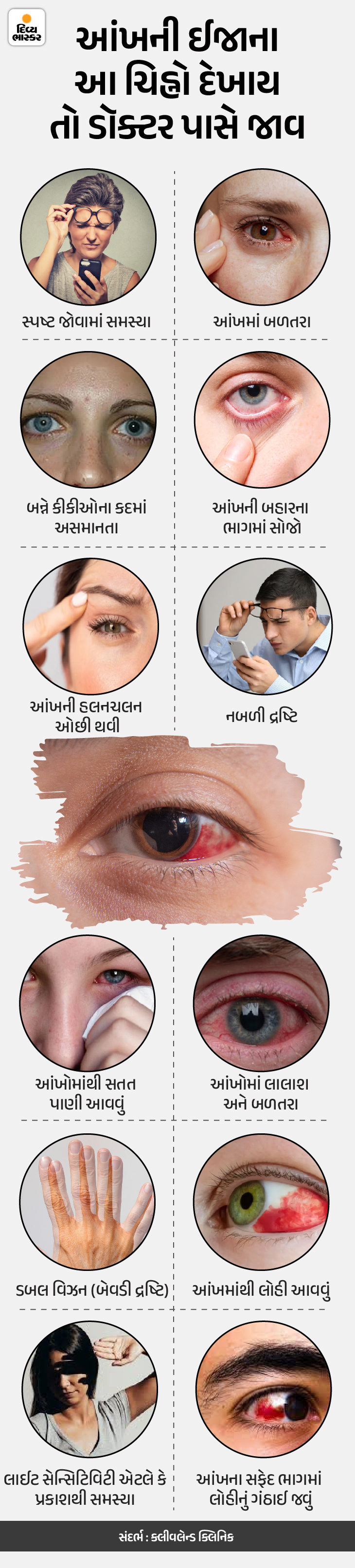 Jasmin Bhasin Eye Injury; Cornea Damage | Contact Lenses Side Effects ...