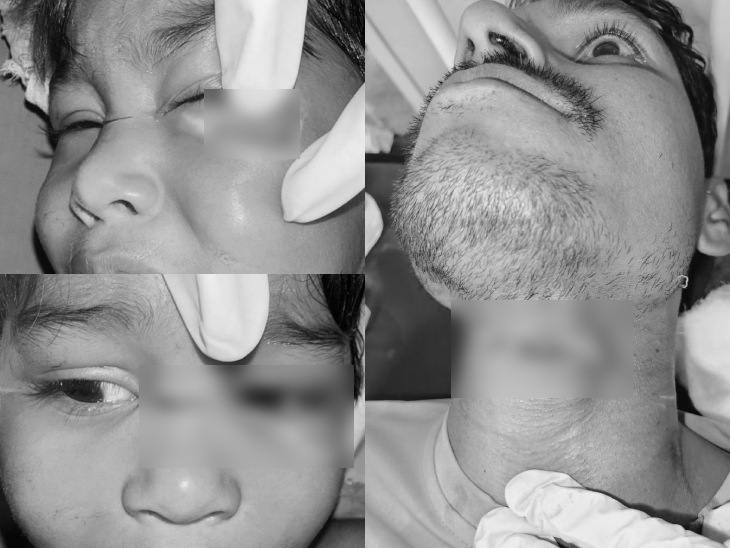 Vadodara Kite String Injuries: 5 Major Surgeries, Trachea Cut Patient Saved