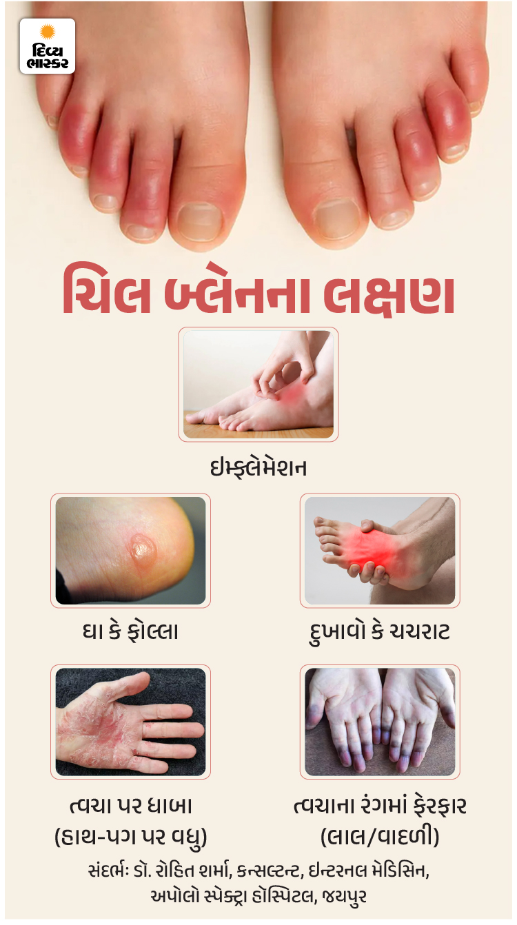 Chill Blains: Swollen Fingers in Cold Weather? Doctor Explains Prevention