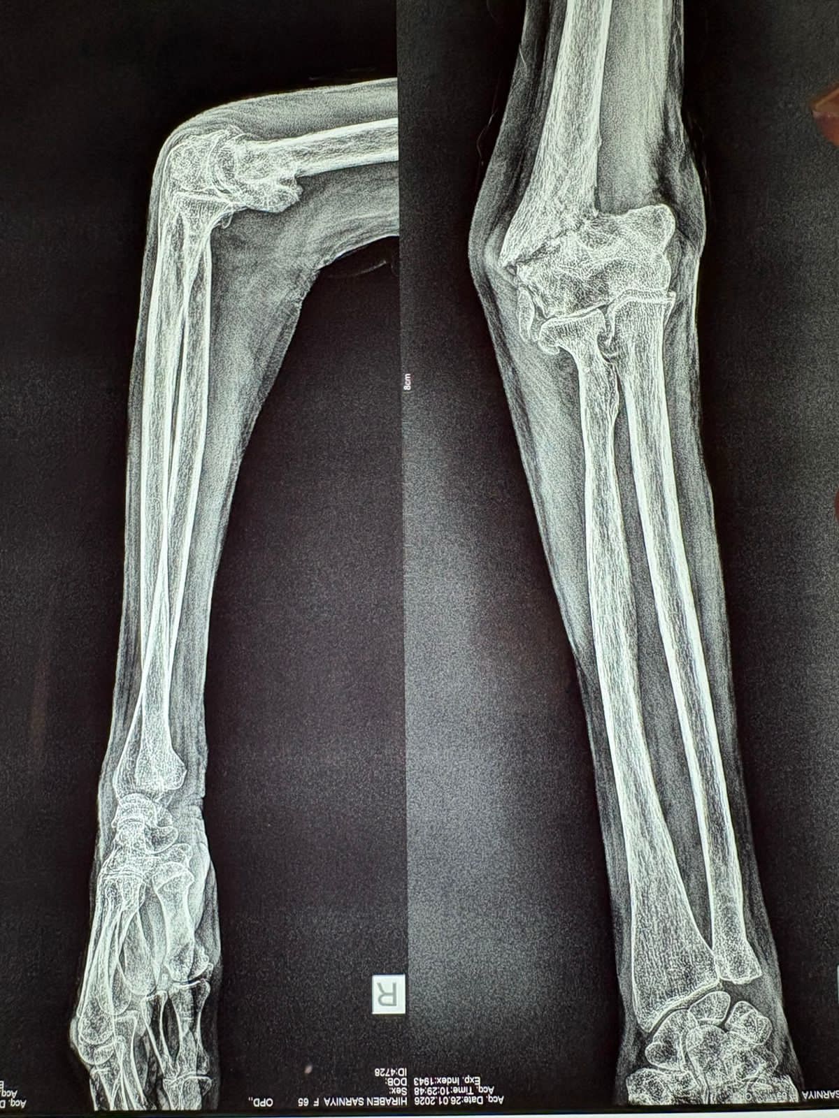 Gotri Hospital Doctors Perform Rare Joint Replacement Surgeries ...