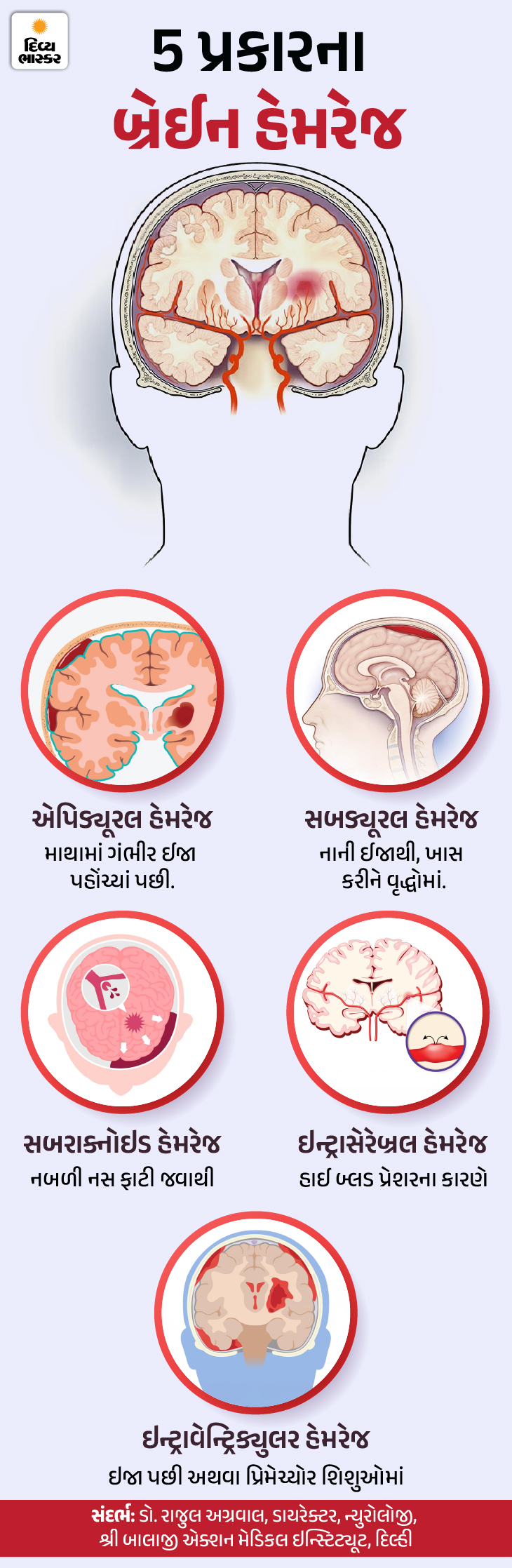 Brain Hemorrhage: Mumbai Neurologist Explains Early Signs & Risk