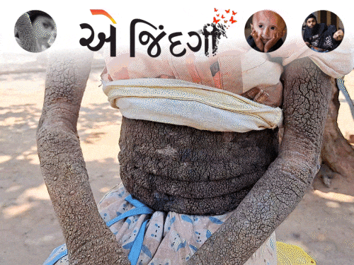 Gujarat Boys Rare Skin Disease; Body Turns Tree Bark At 14